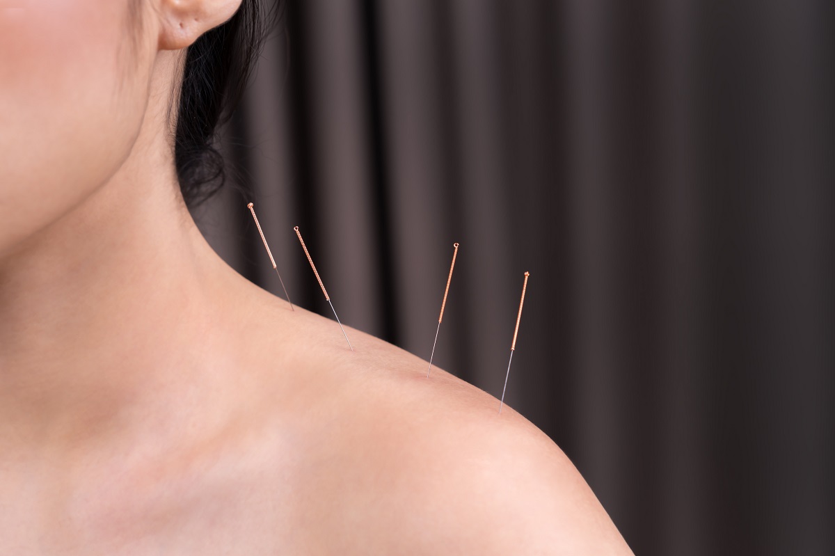 Acupuncture - Harmonizing Chinese Medicine Clinic